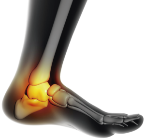 Dolor de tobillo - Medipase